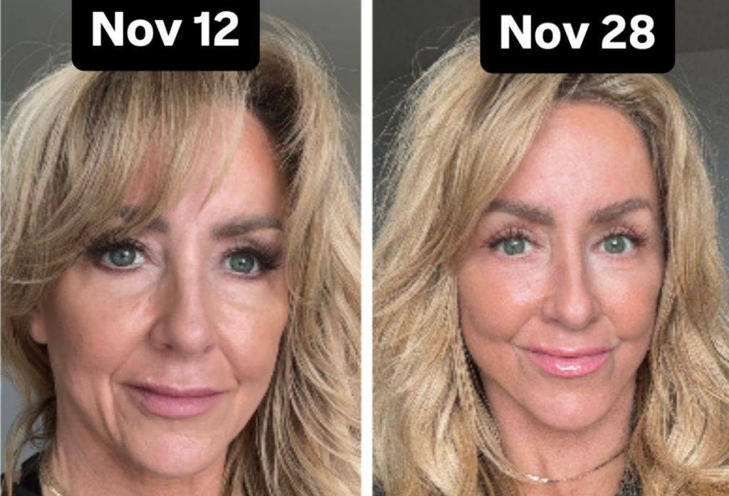 Chalene Johnson’s Facelift: Every Single Detail - CHALENE JOHNSON
