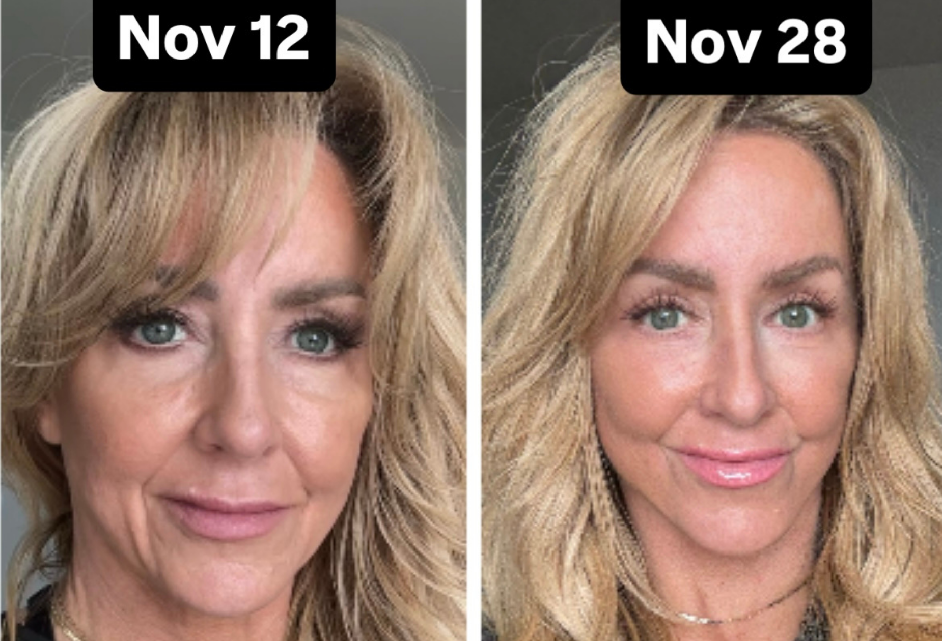Chalene Johnson’s Facelift: Every Single Detail - CHALENE JOHNSON